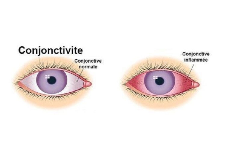 Soigner une conjonctivite au naturel