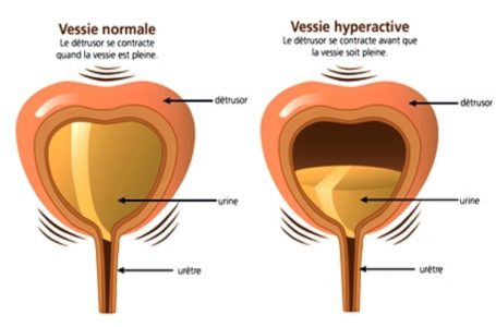 Une vessie hyperactive, de quoi s'agit-il